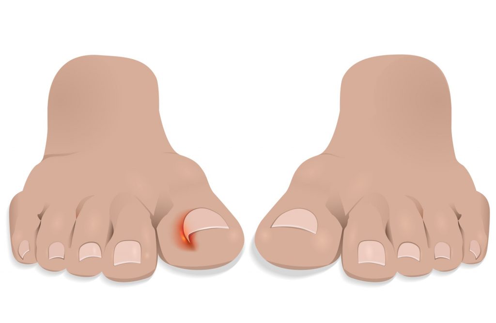 Nail surgery and ingrowing toenails – Exmouth Podiatry